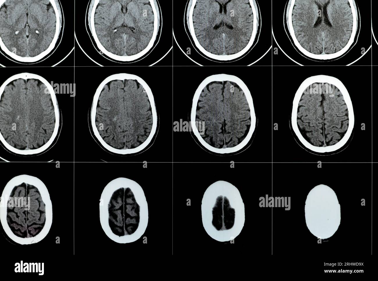 Multi slice CT scan of the brain showing Large brain stem and right ...