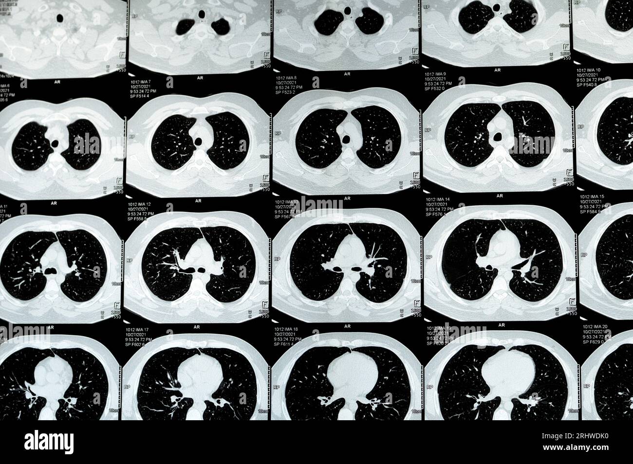 Multi slice CT scan of the chest showing normal study, normal ...