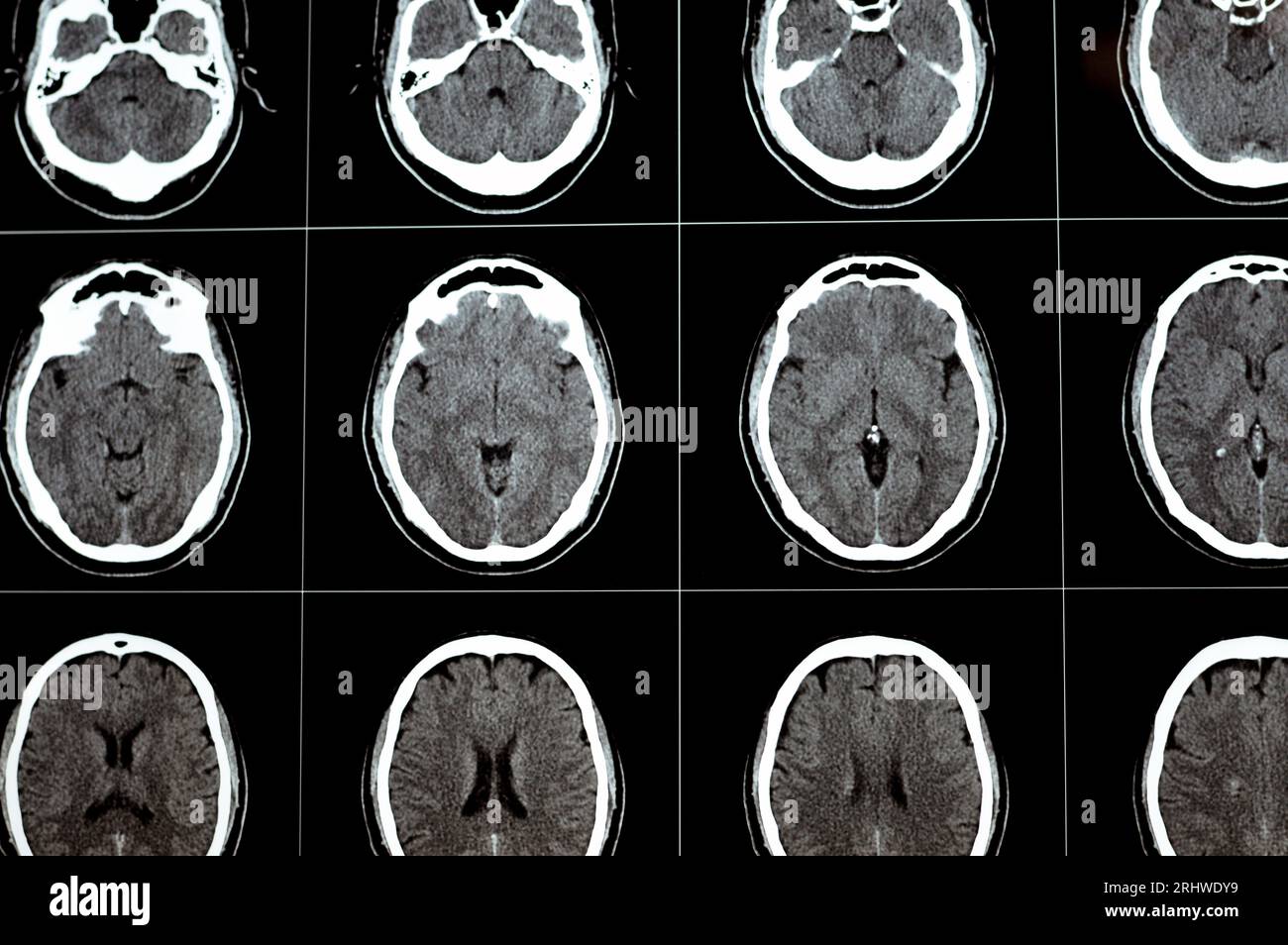 Brain CT scan showing brainstem cavernoma, right centrum semiovale ...