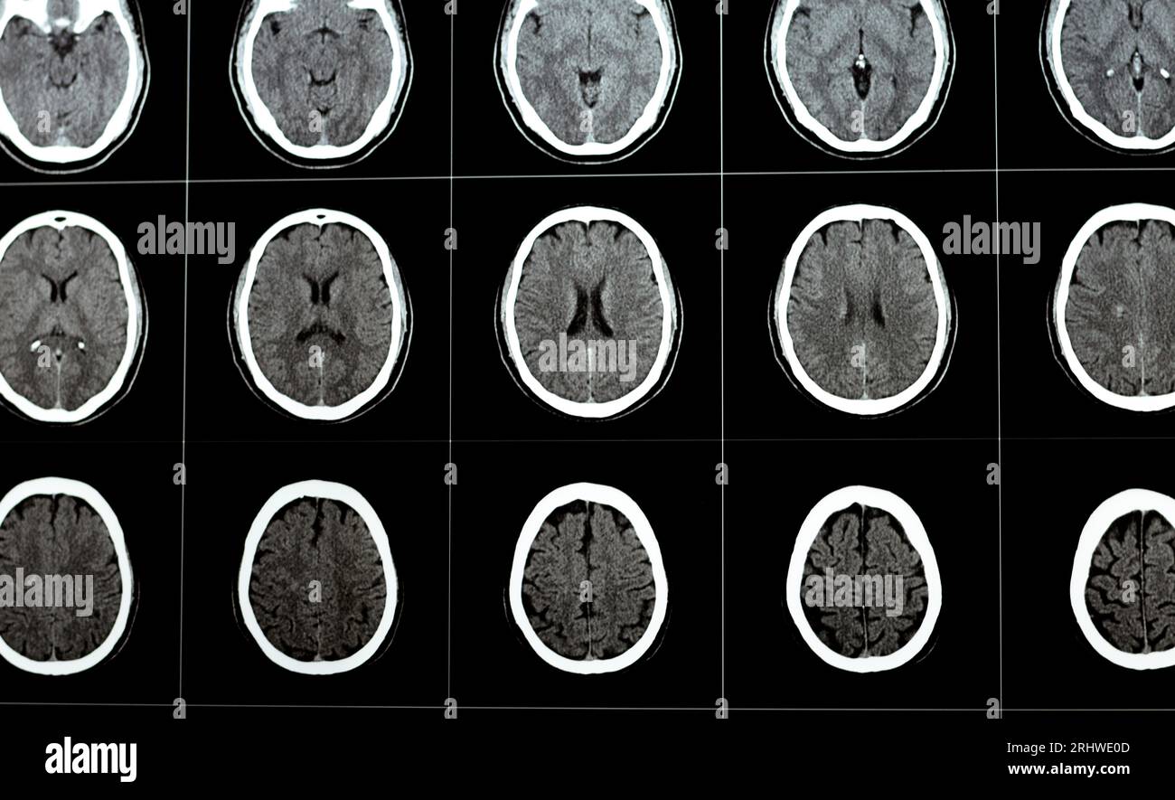Brain CT scan showing brainstem cavernoma, right centrum semiovale ...