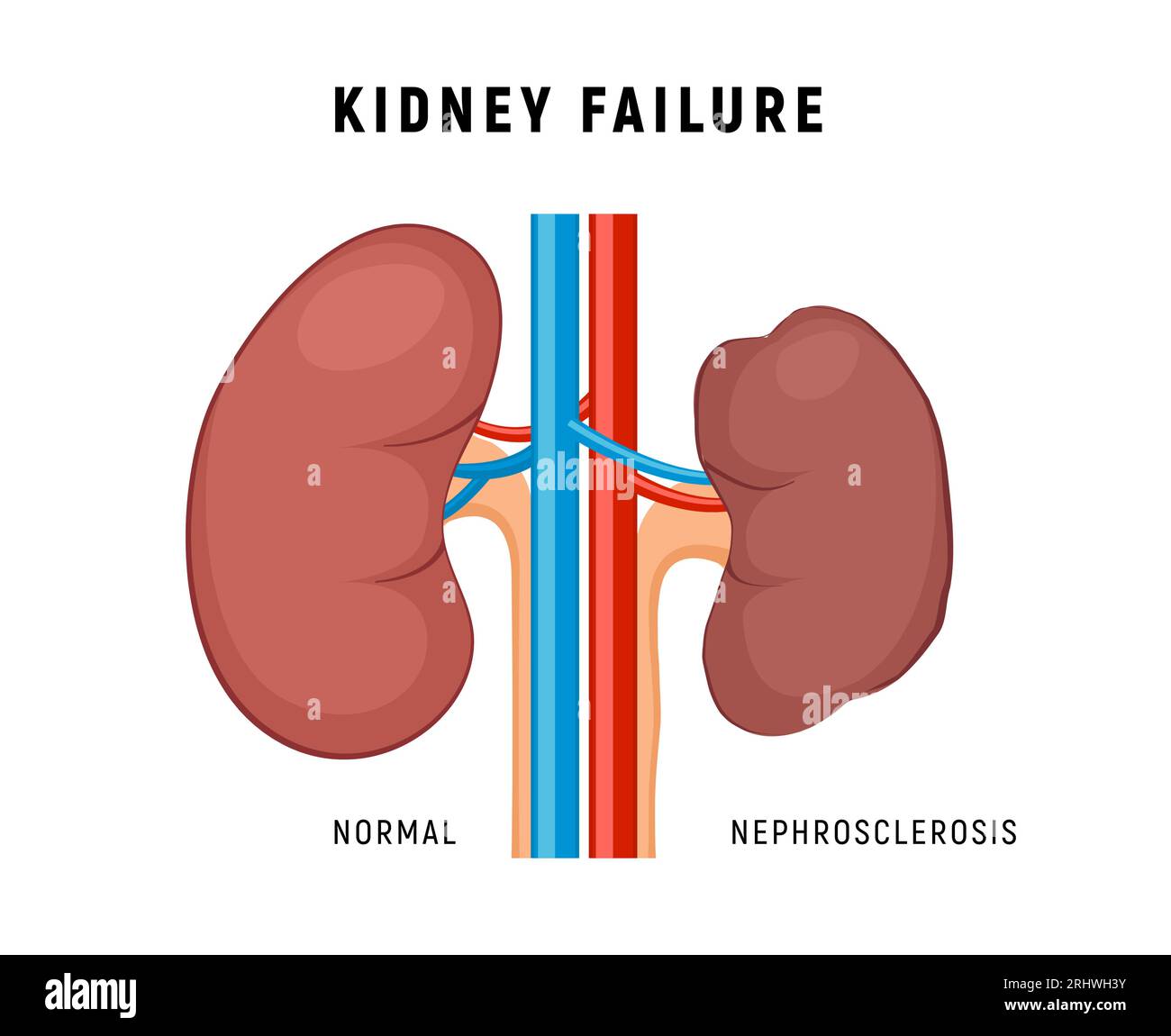 Chronic Kidney Disease Histology Kidney Failure Disease