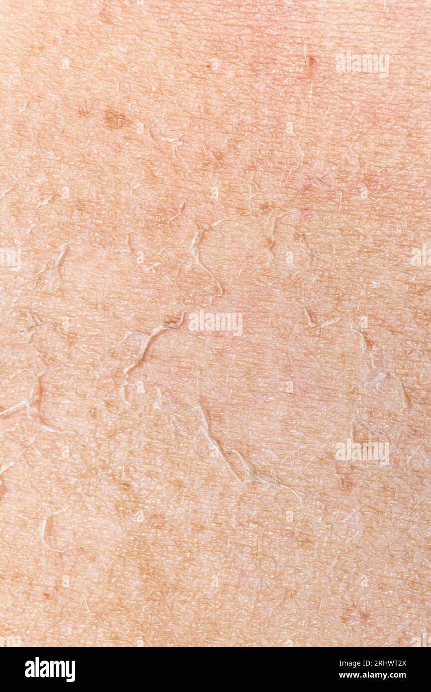 Macro of human dry skin damaged by sun uv rays. Close-up of a Caucasian ...