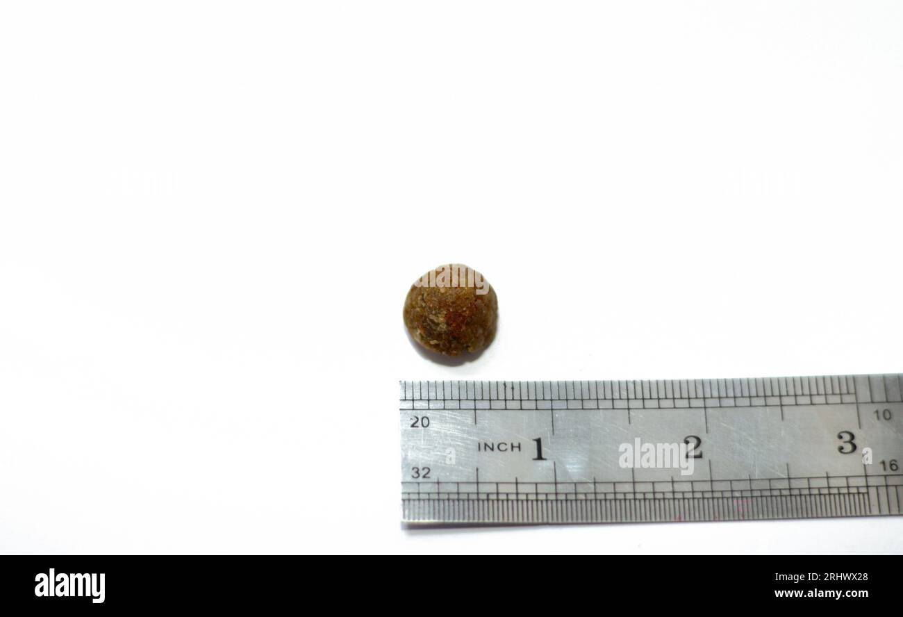 Large gallstone removed surgically after laparoscopic cholecystectomy ...