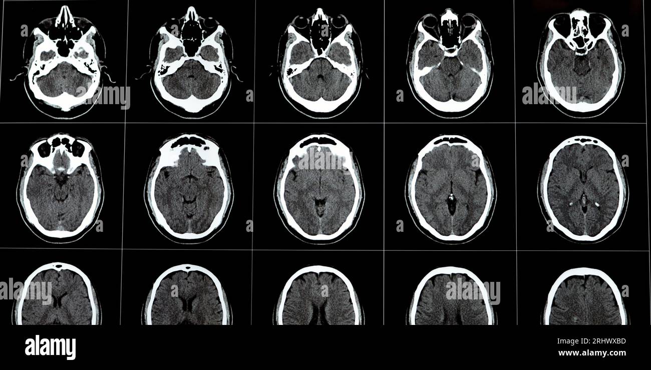Brain CT scan showing brainstem cavernoma, right centrum semiovale ...