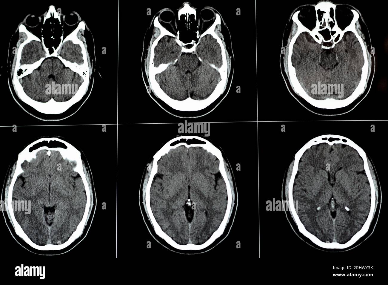 Brain CT scan showing brainstem cavernoma, right centrum semiovale ...