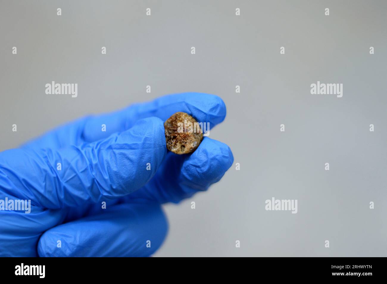 Large gallstone removed surgically after laparoscopic cholecystectomy ...