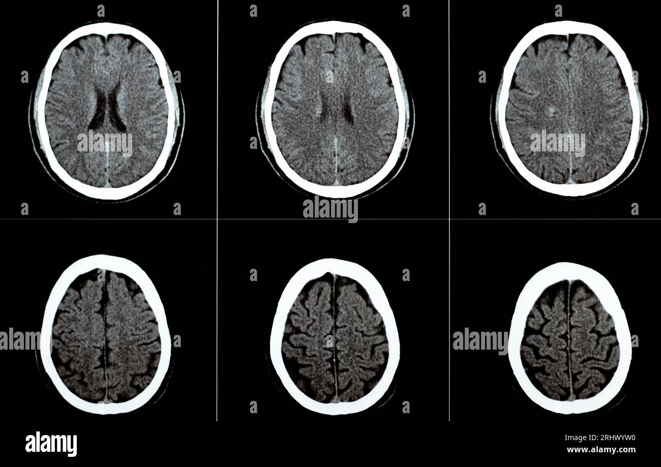 Brain CT scan showing brainstem cavernoma, right centrum semiovale ...