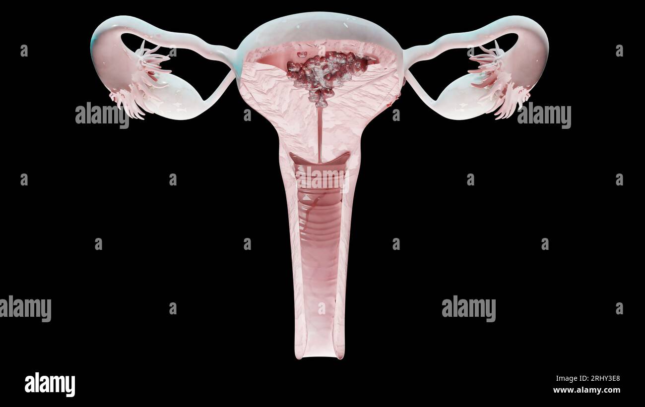 uterus malignant tumor, Female uterus anatomy, Reproductive system ...