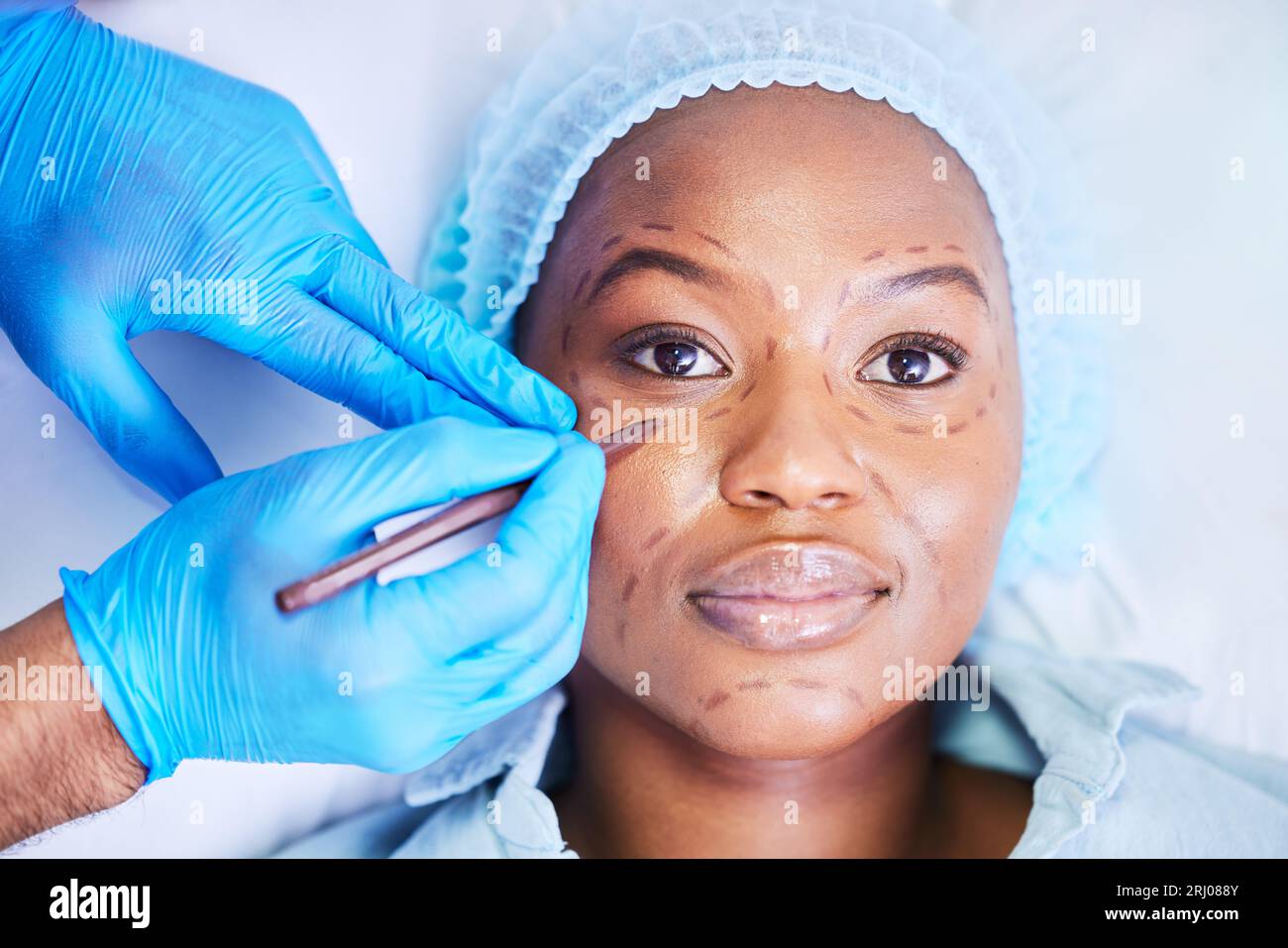 Plastic surgery, pen and black woman portrait on a hospital bed with ...