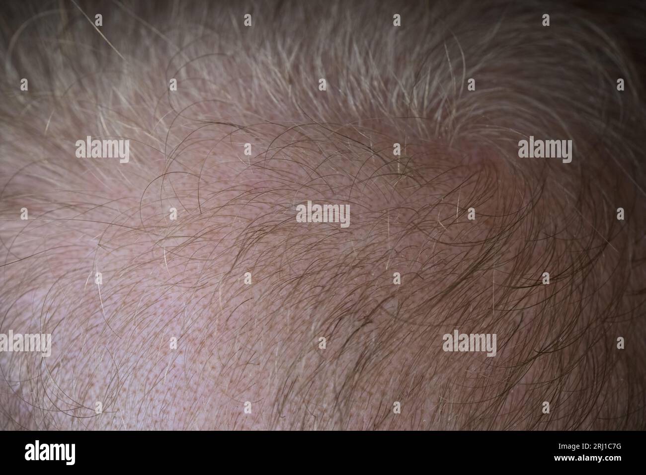 Hair problem hi-res stock photography and images - Alamy