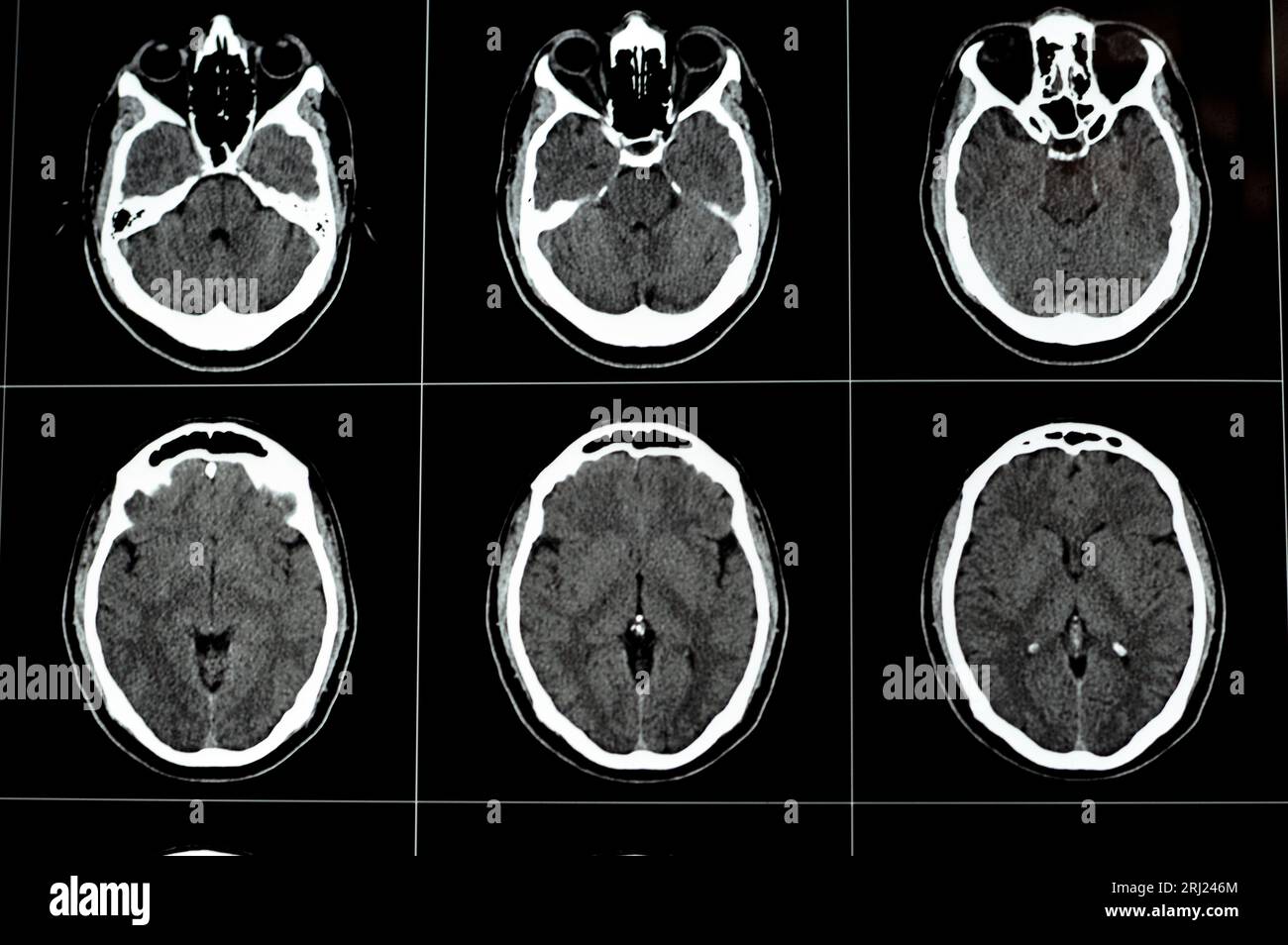 Brain CT scan showing brainstem cavernoma, right centrum semiovale ...