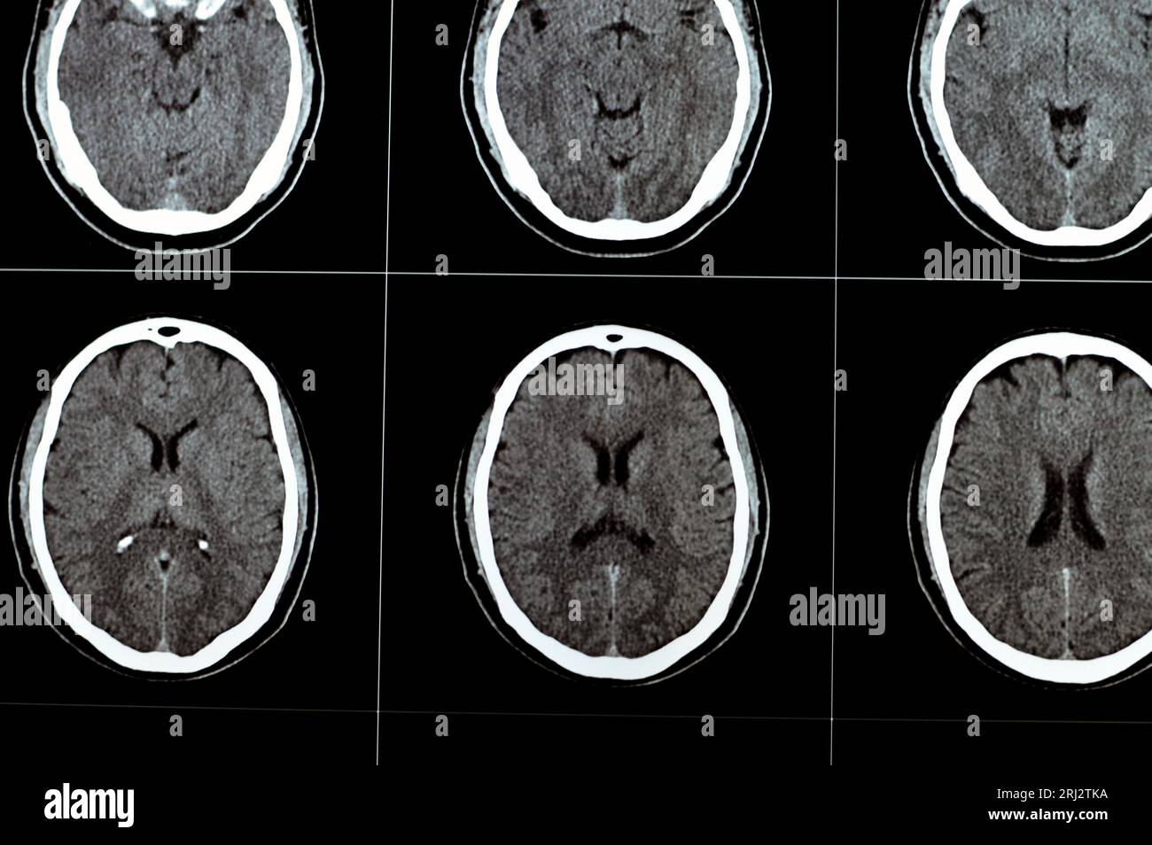 Brain CT scan showing brainstem cavernoma, right centrum semiovale ...