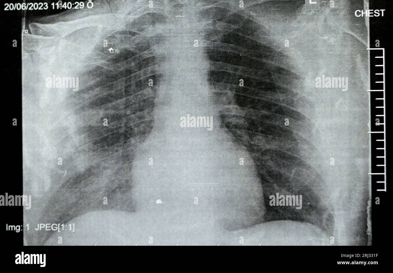 Plain x ray chest showing infectious pulmonary process pneumonia with ...