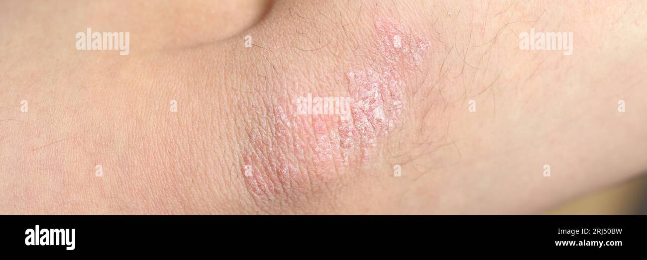 Dry itchy skin on the elbow area close up Stock Photo - Alamy