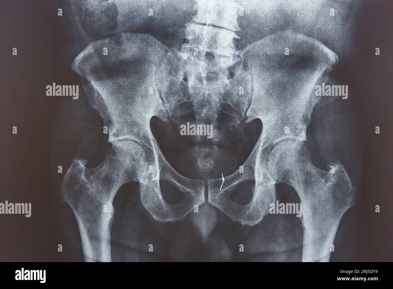 Hip xray. Gold thread attached on the bone. Medical examination Stock ...