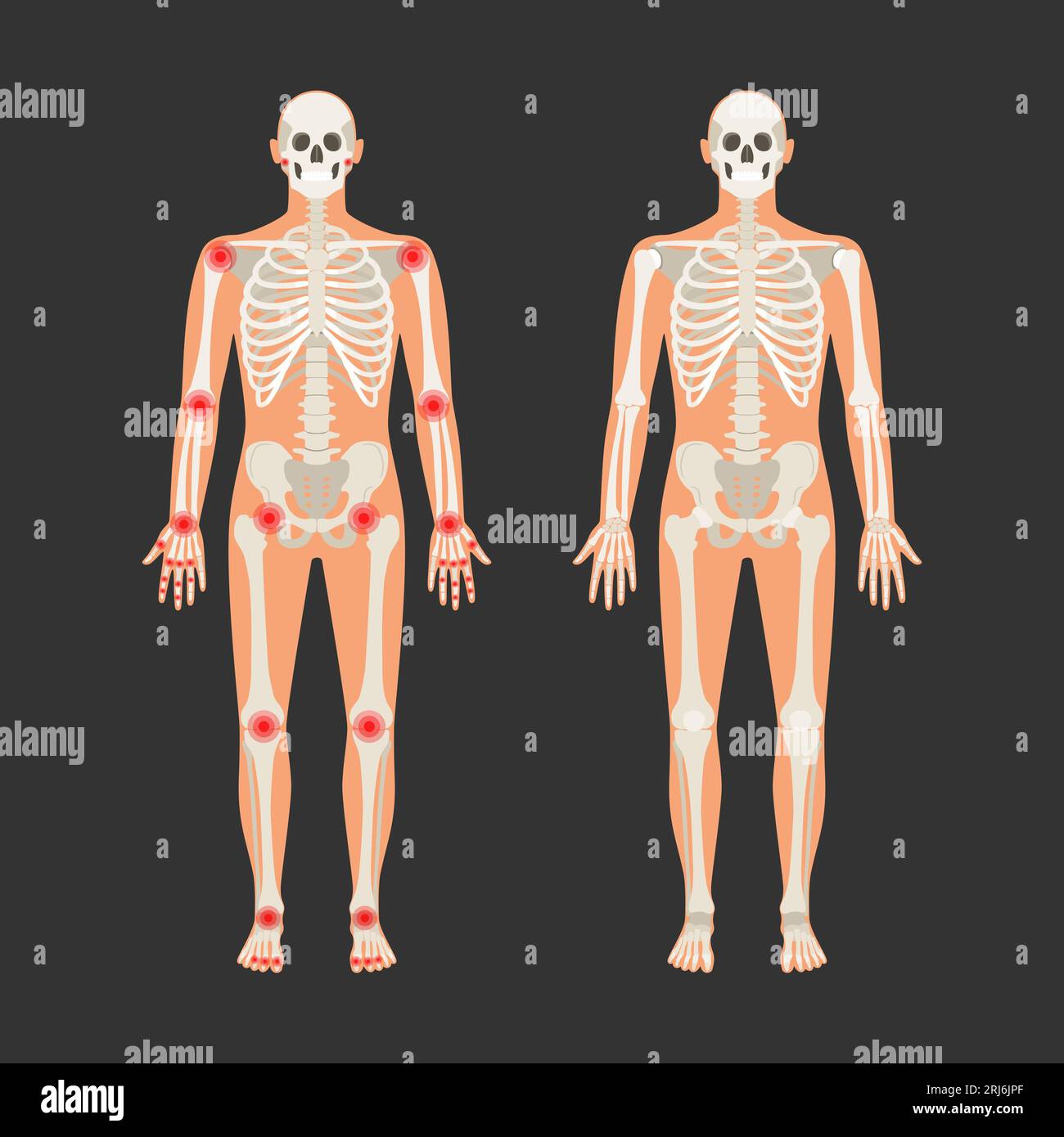 Human skeleton with pain points in rheumatoid arthritis. Men anatomy ...