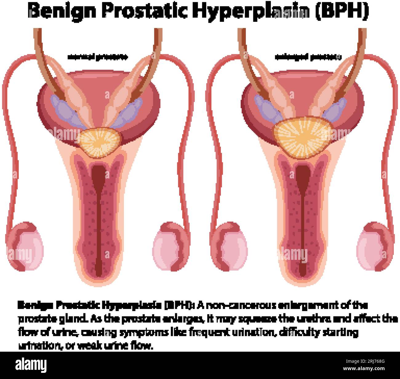 Cartoon-style infographic illustrating male benign prostatic hyperplasia Stock Vector Image ...