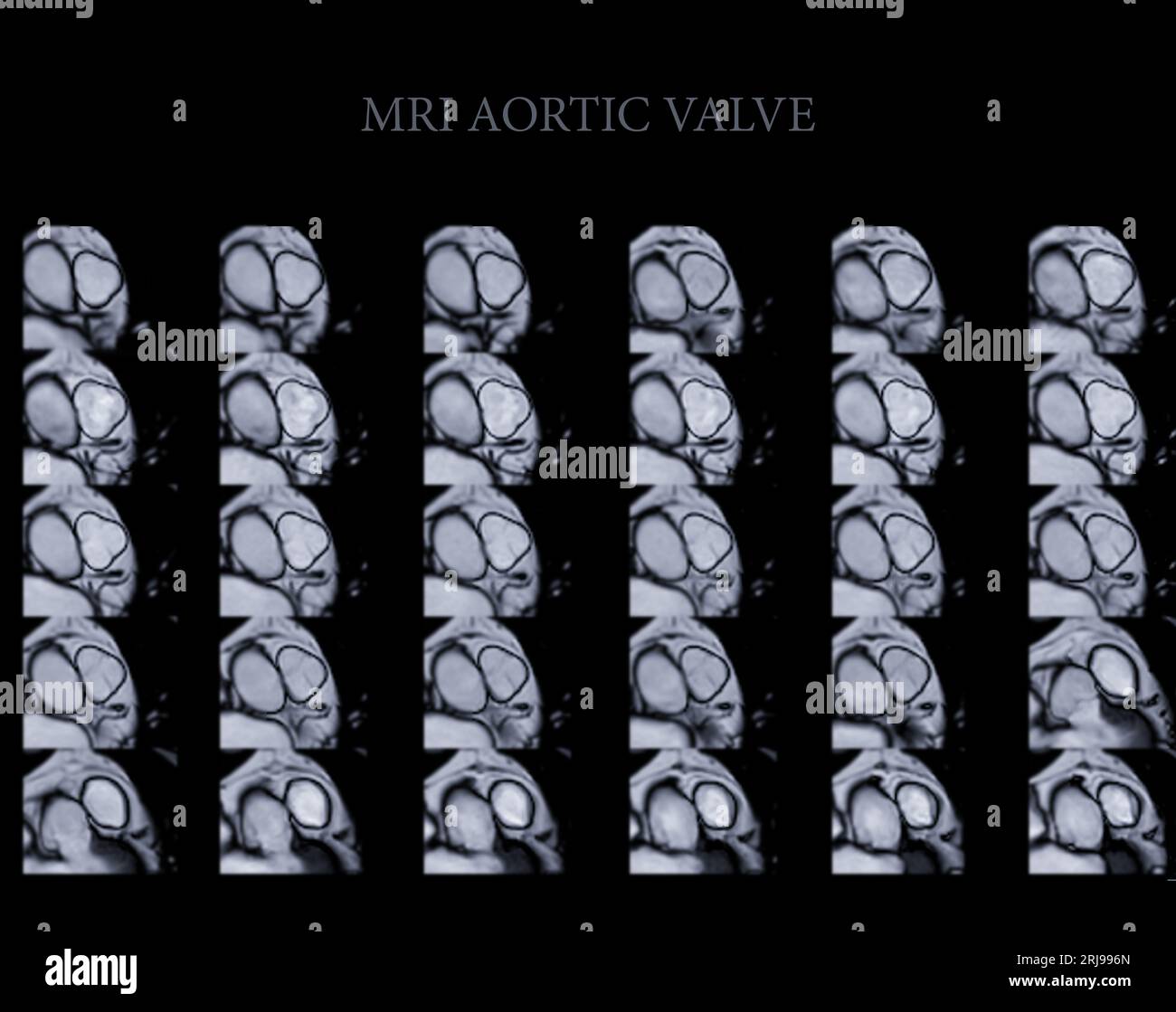 MRI heart or Cardiac MRI ( magnetic resonance imaging ) of heart for ...