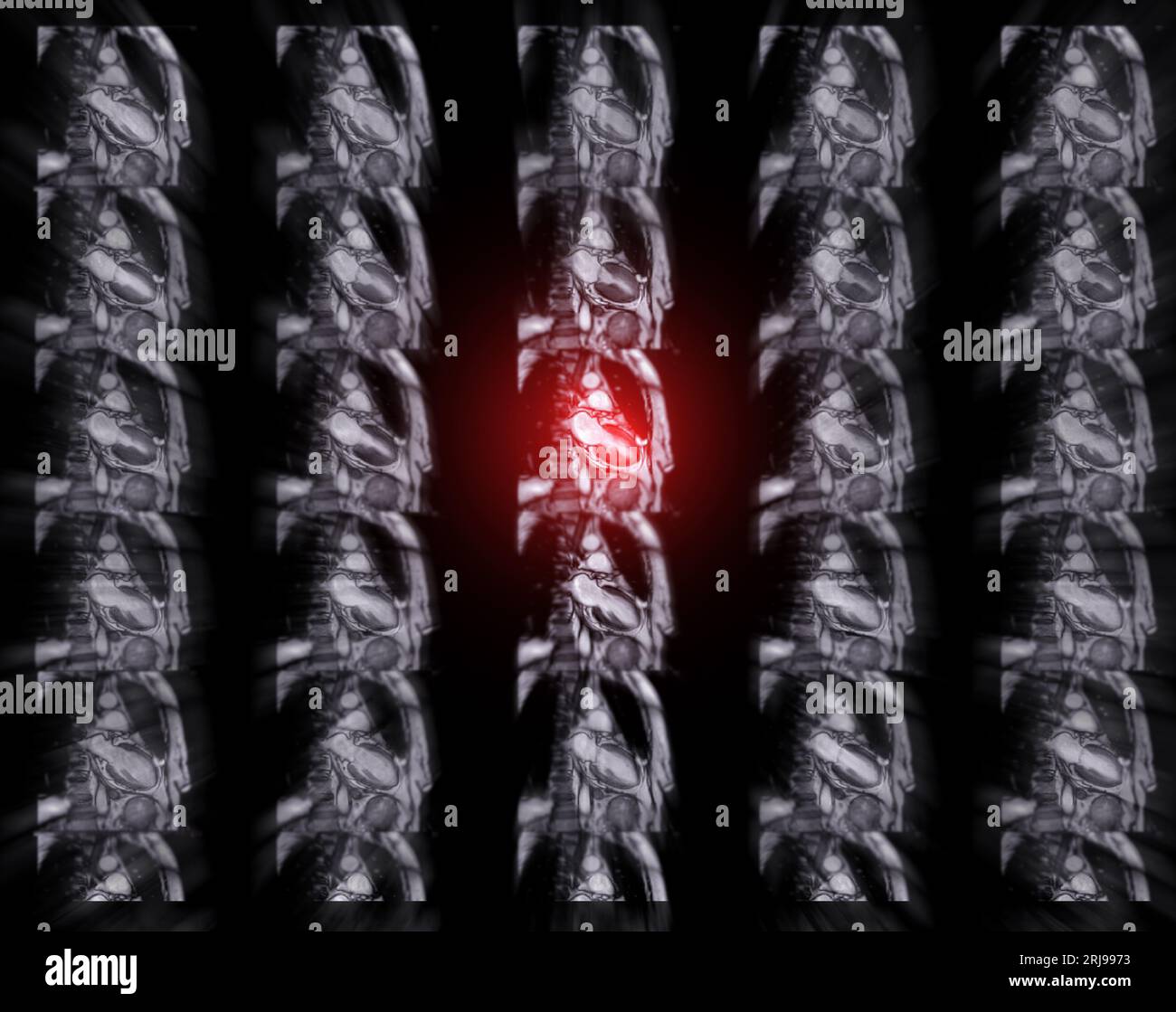MRI heart or Cardiac MRI ( magnetic resonance imaging ) of heart for ...