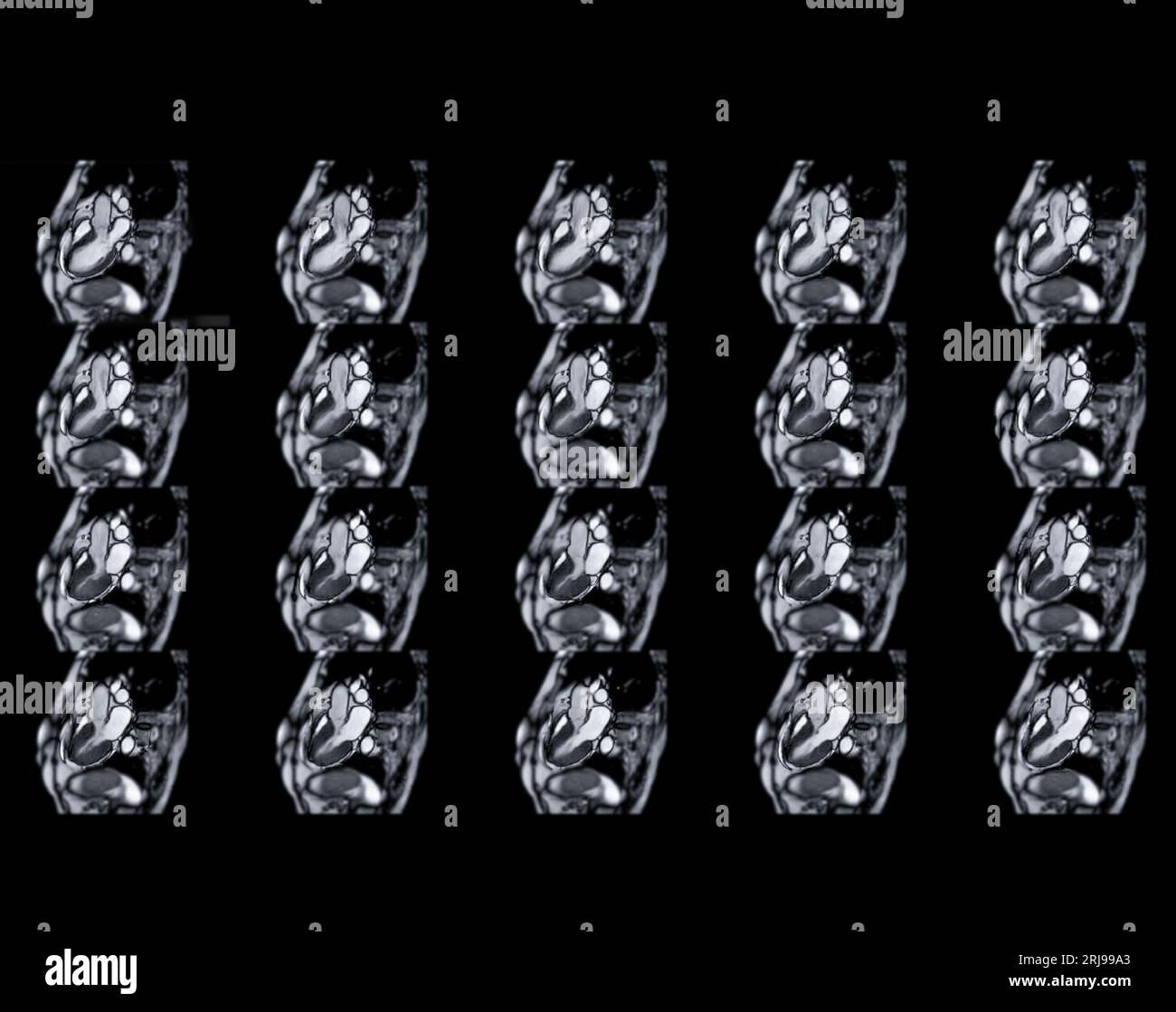 MRI heart or Cardiac MRI ( magnetic resonance imaging ) of heart for ...