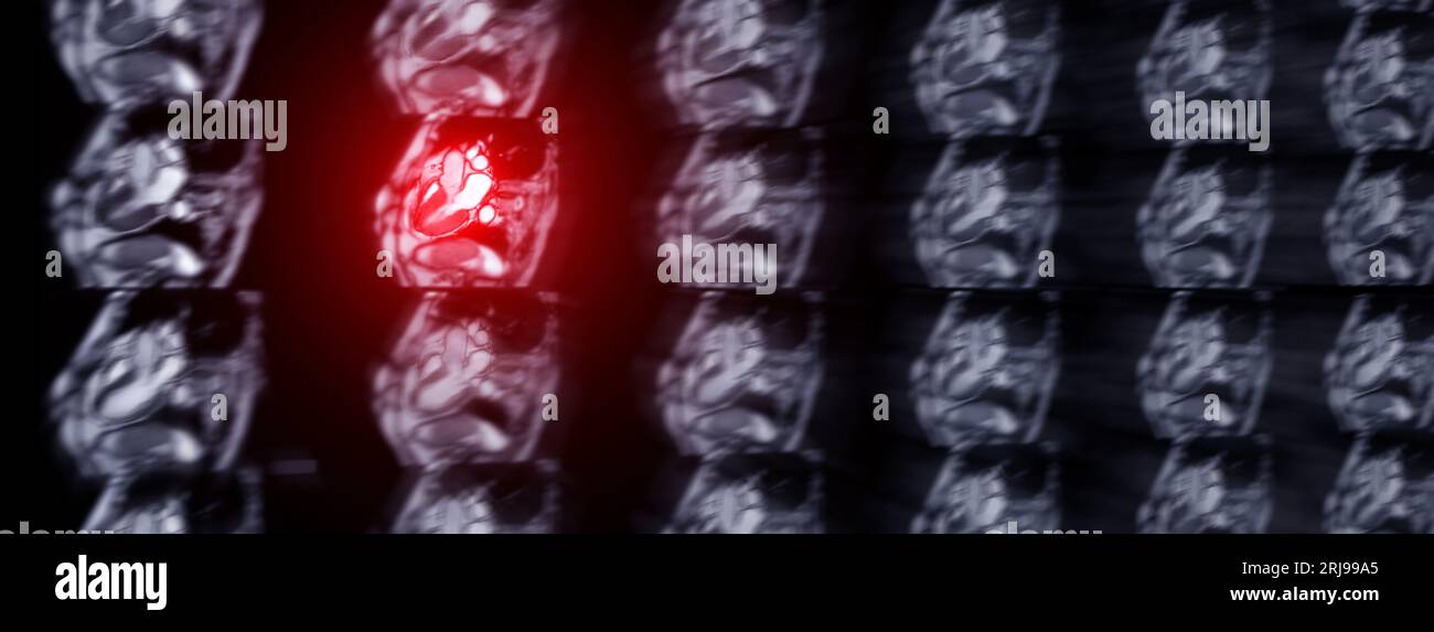 MRI heart or Cardiac MRI ( magnetic resonance imaging ) of heart for ...