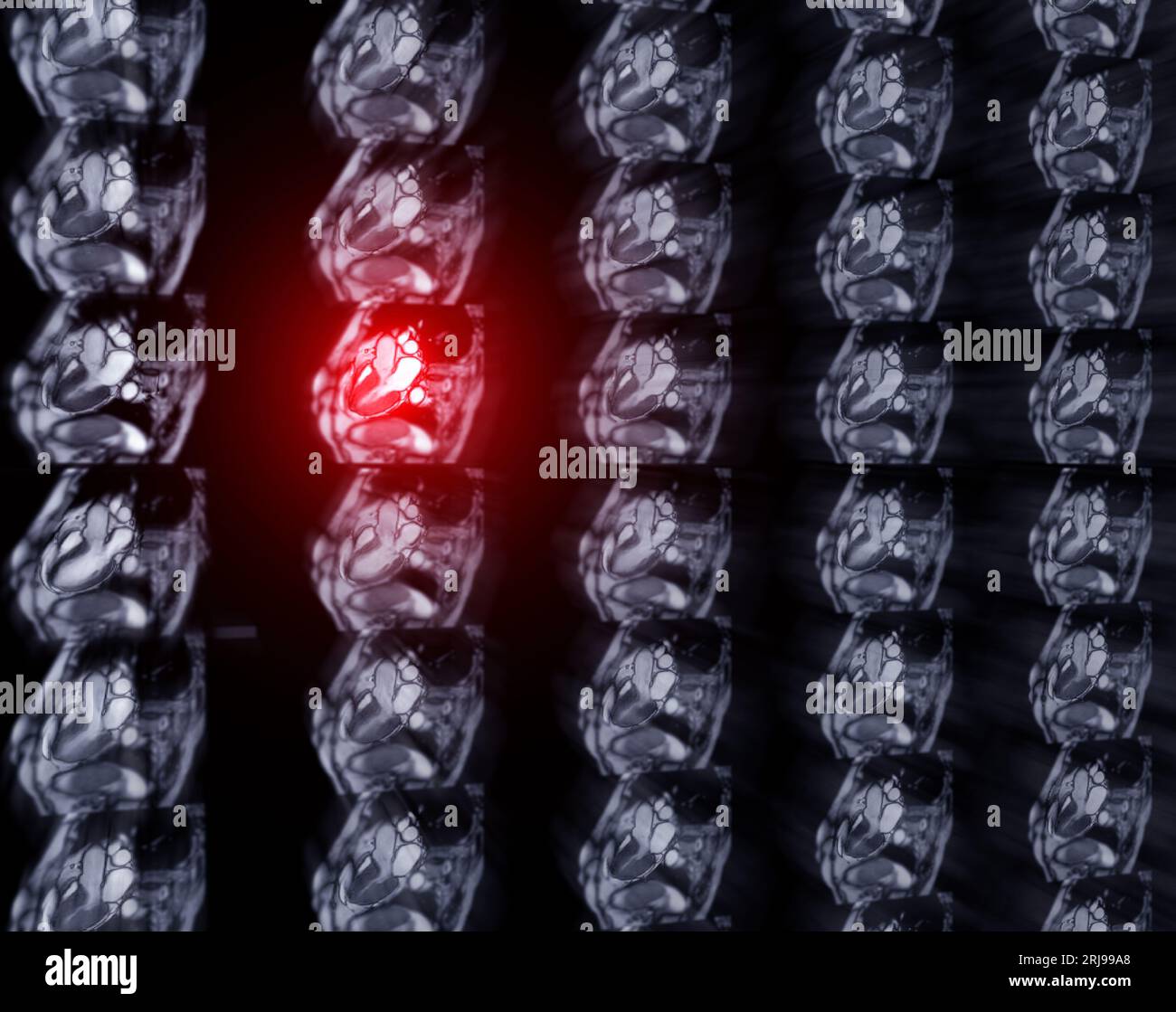 MRI heart or Cardiac MRI ( magnetic resonance imaging ) of heart for ...