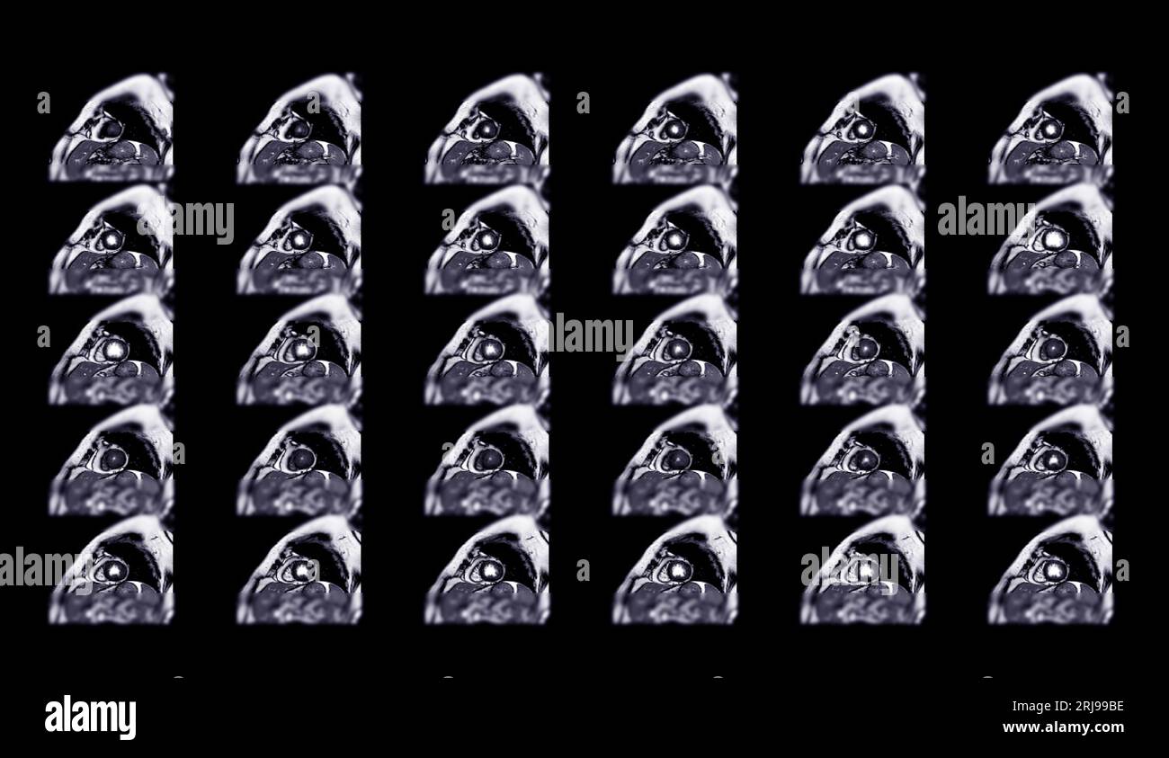 MRI heart or Cardiac MRI ( magnetic resonance imaging ) of heart for ...