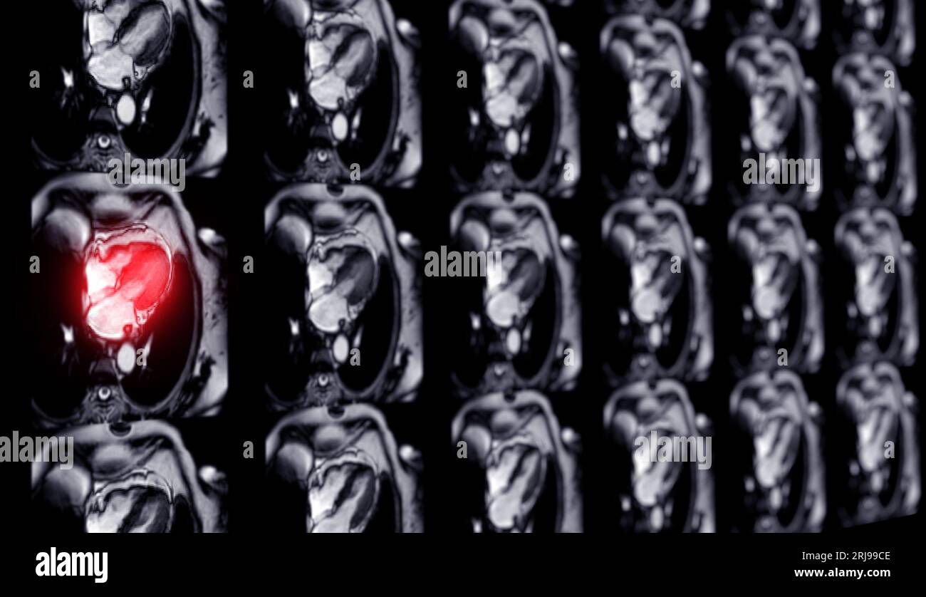 MRI heart or Cardiac MRI ( magnetic resonance imaging ) of heart for ...