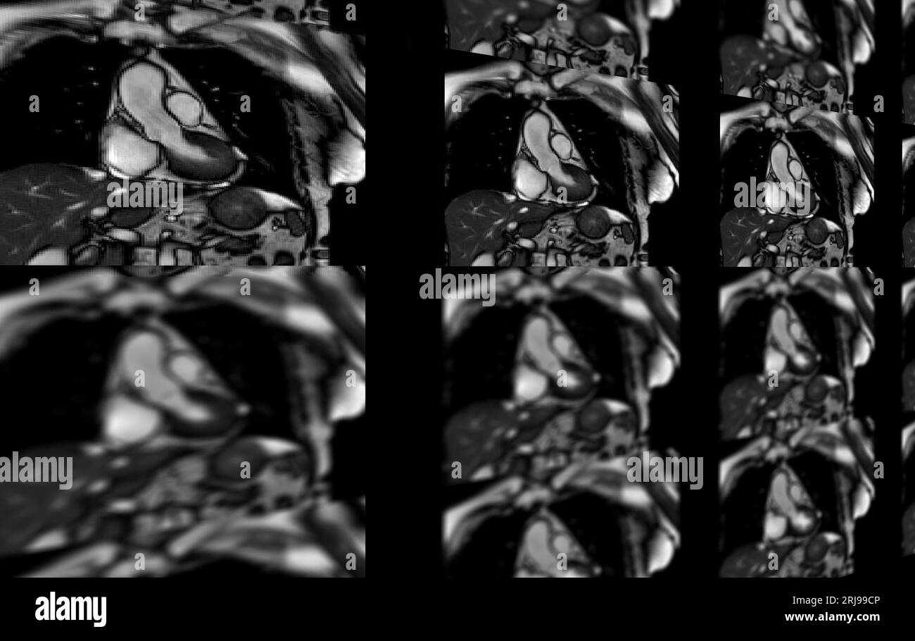 MRI heart or Cardiac MRI ( magnetic resonance imaging ) of heart for ...