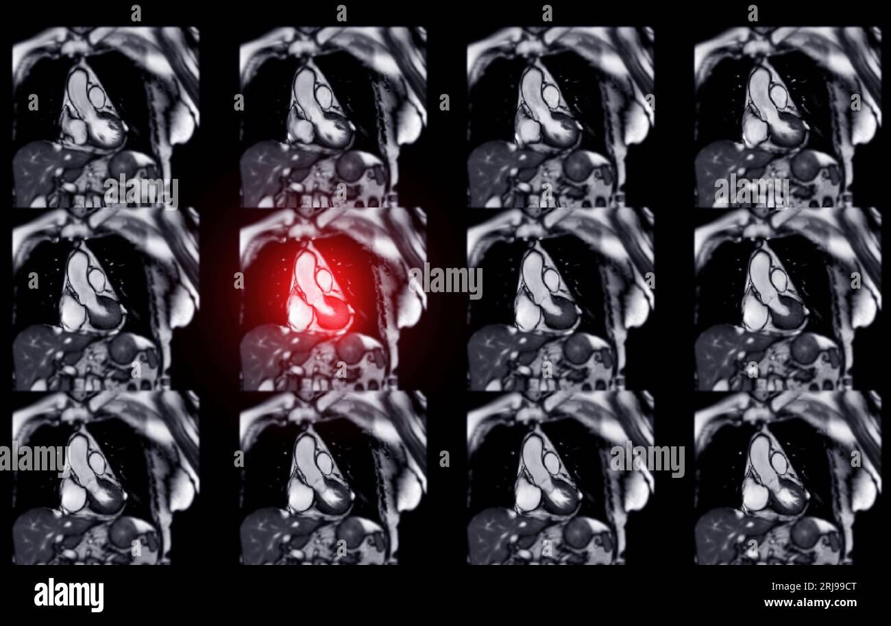 MRI heart or Cardiac MRI ( magnetic resonance imaging ) of heart for ...