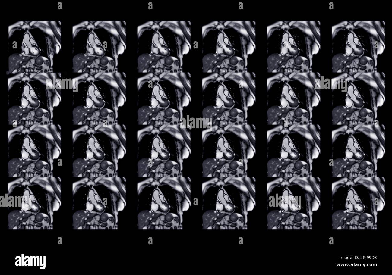 MRI heart or Cardiac MRI ( magnetic resonance imaging ) of heart for ...