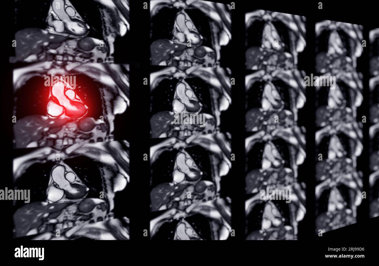MRI heart or Cardiac MRI ( magnetic resonance imaging ) of heart for ...
