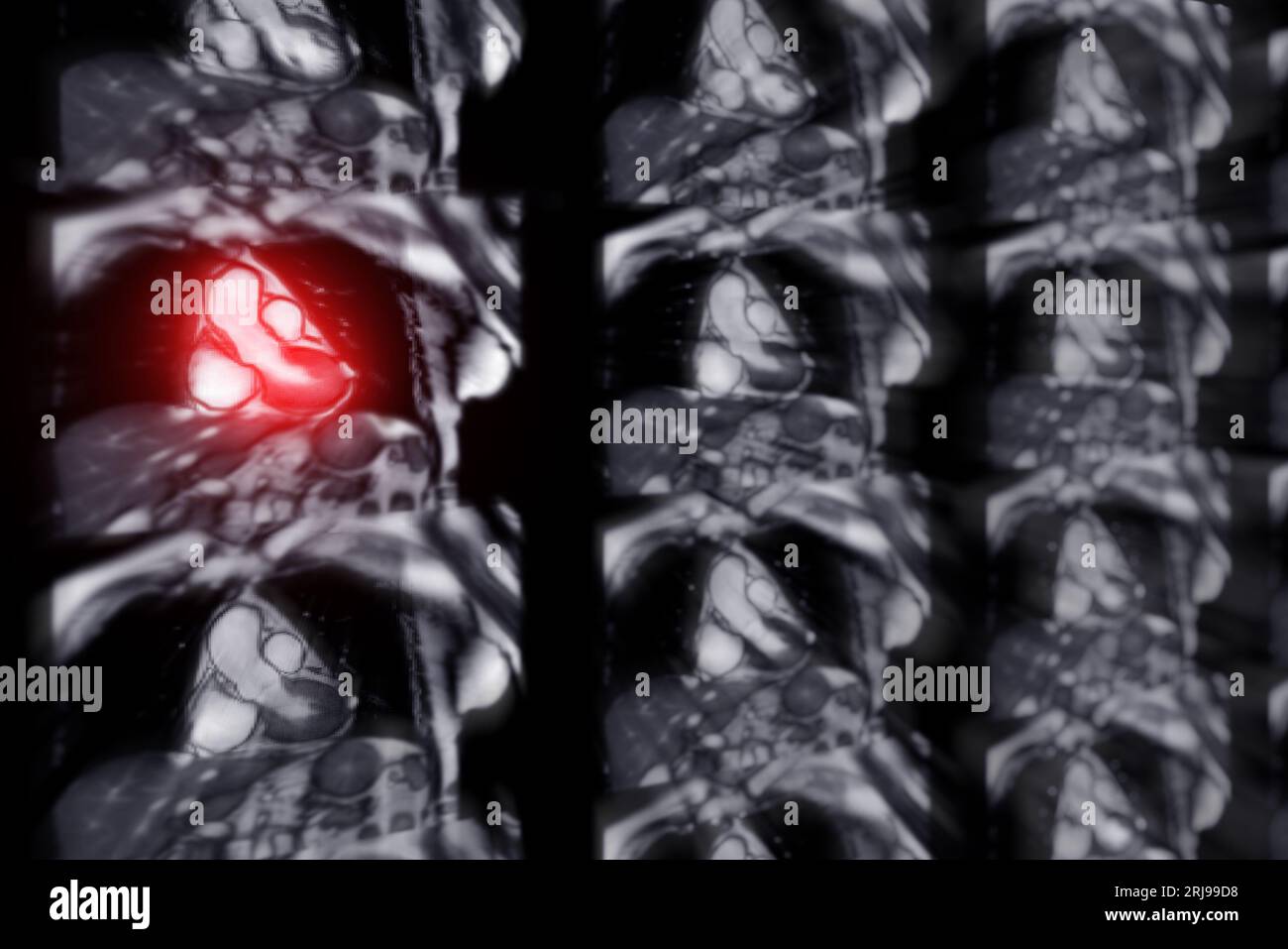 MRI heart or Cardiac MRI ( magnetic resonance imaging ) of heart for ...