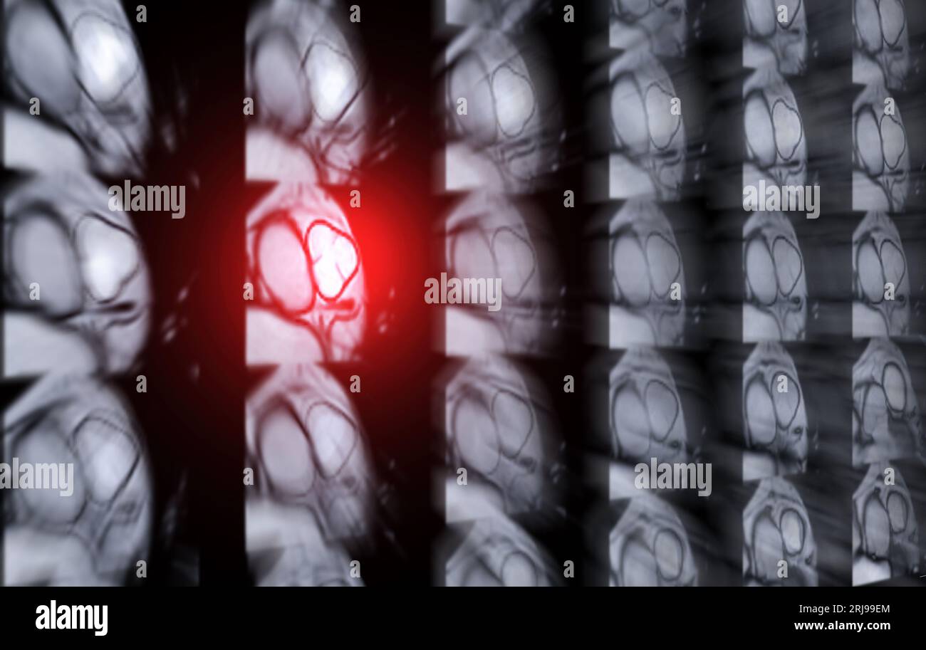 MRI heart or Cardiac MRI ( magnetic resonance imaging ) of heart for ...