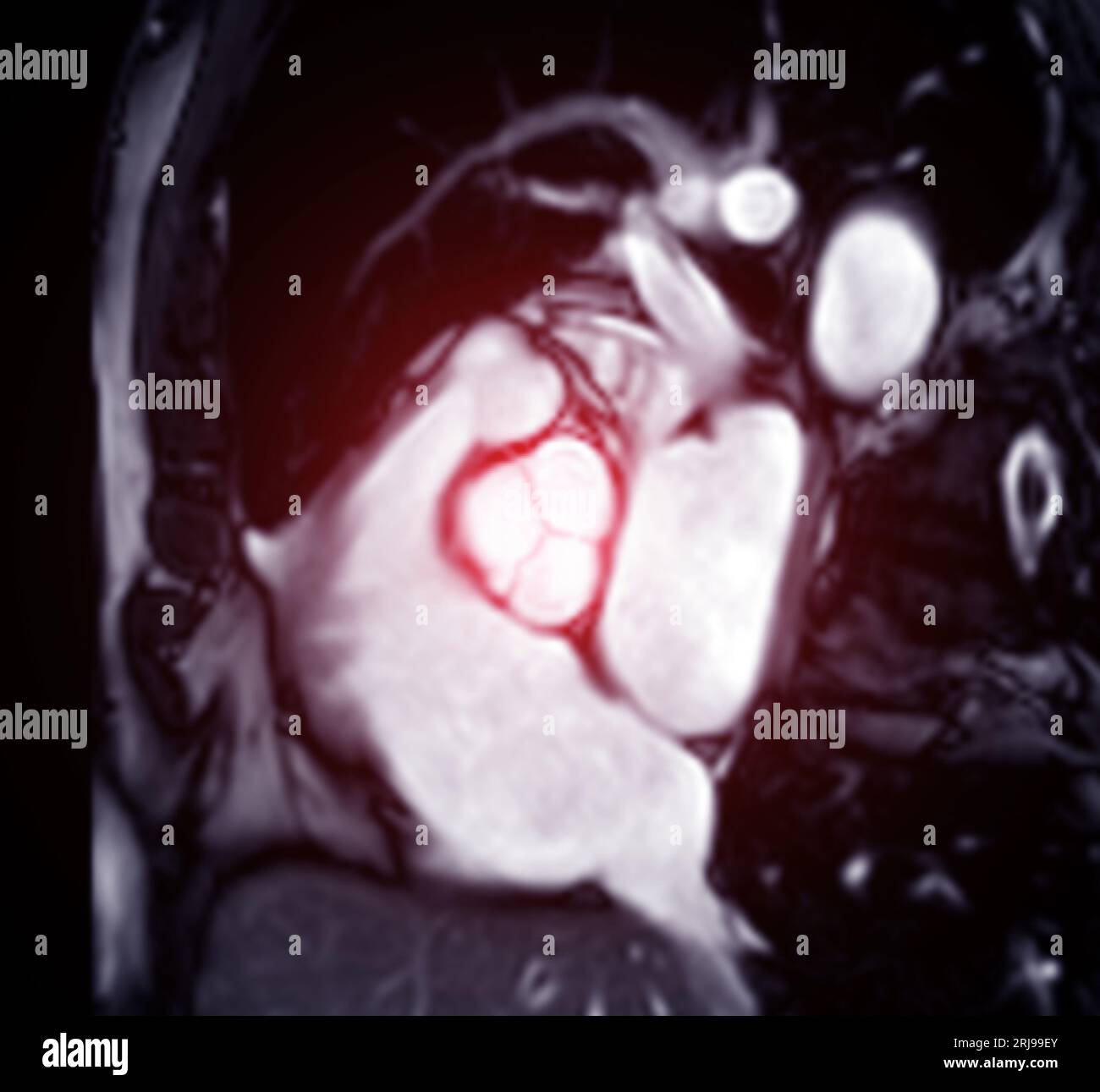 MRI heart or Cardiac MRI ( magnetic resonance imaging ) of heart for ...
