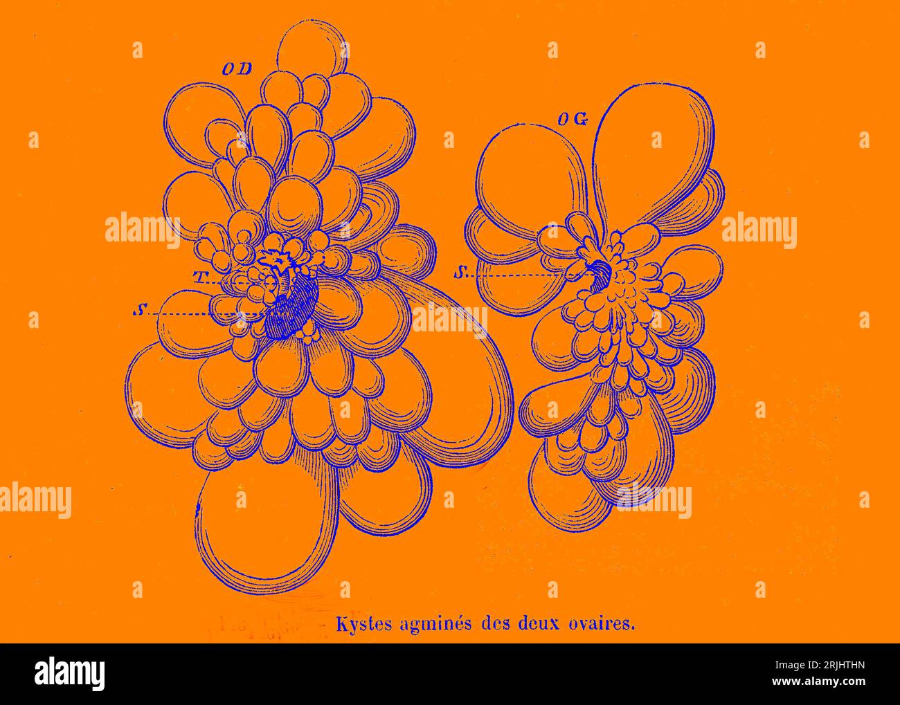 Ovarian cysts, illustration Stock Photo - Alamy