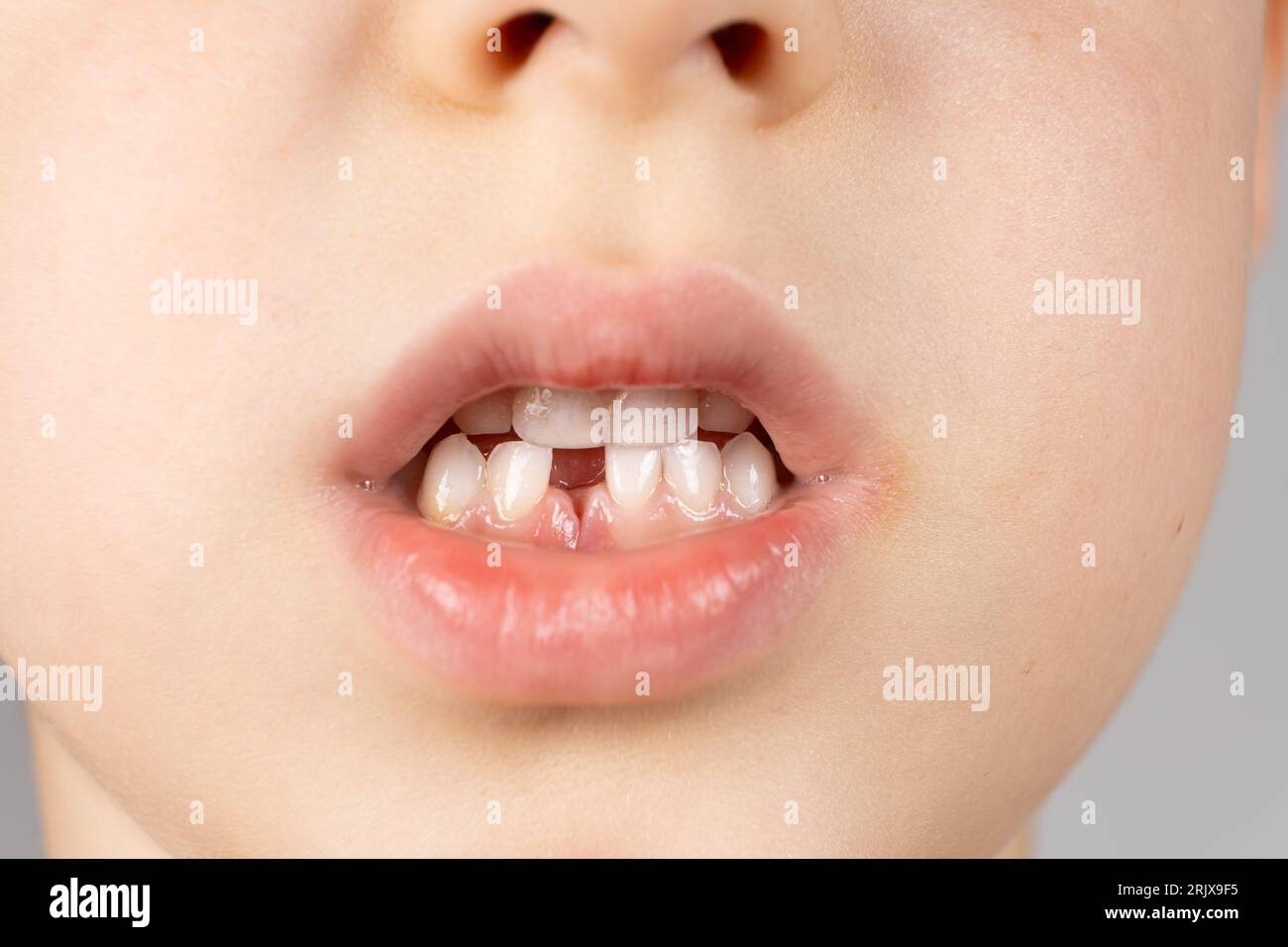 Loss of milk teeth in children. A six-year-old child shows the first ...