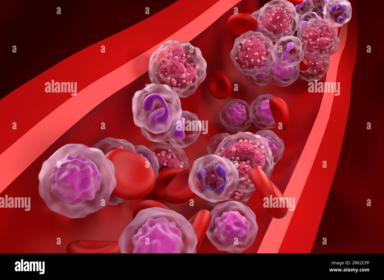 Acute lymphoblastic leukemia (ALL) cancer cells in the blood flow ...