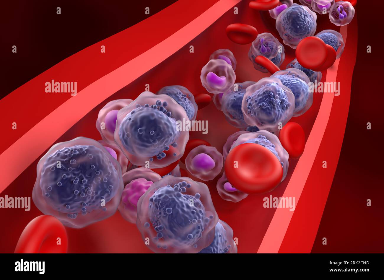 Acute myeloid leukemia (AML) cells in blood flow - closeup view 3d ...