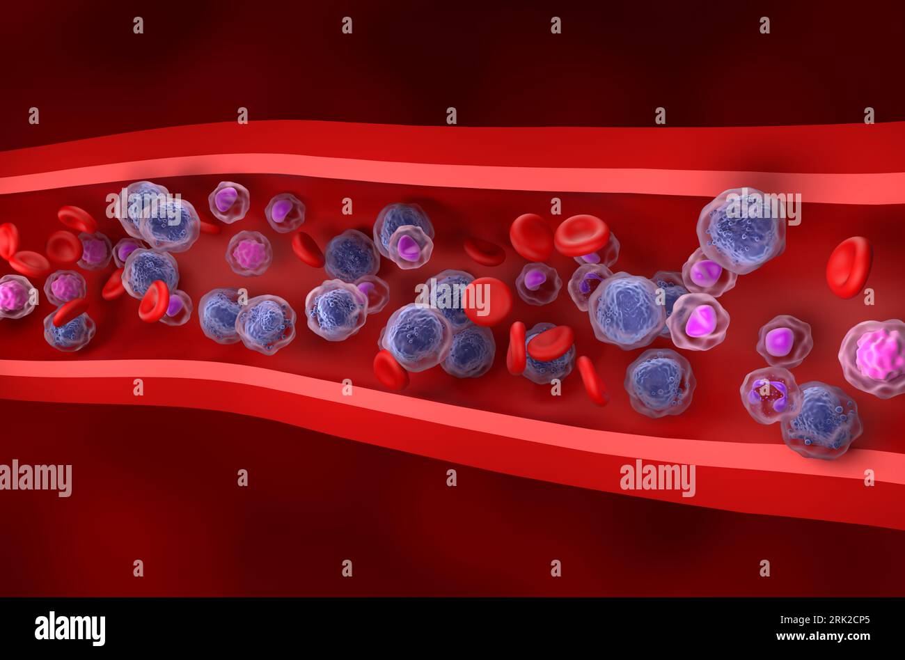 Acute myeloid leukemia (AML) cells in blood flow - isometric view 3d ...