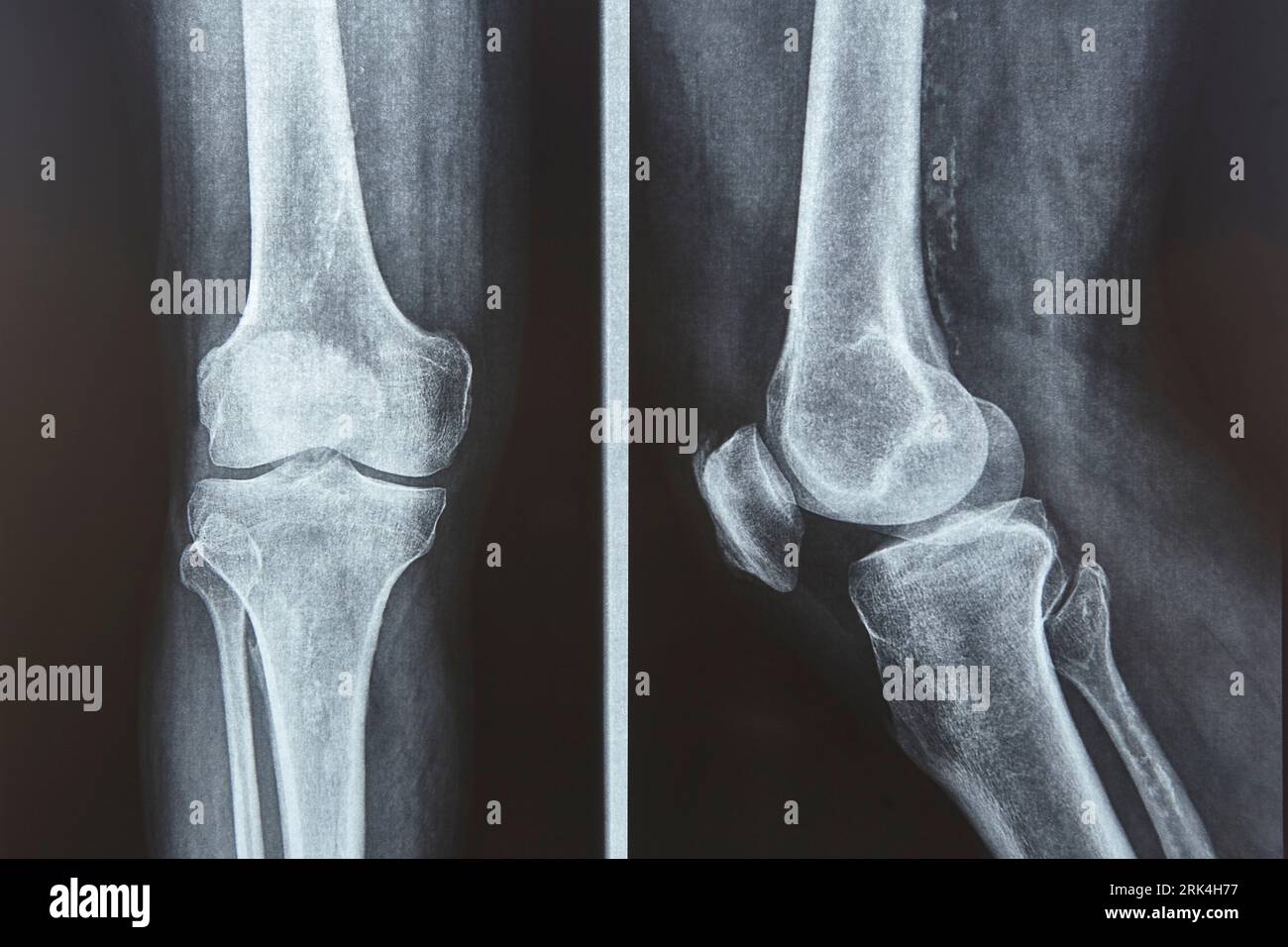 Knee xray. Front and lateral view. Healthcare. Image diagnosis Stock ...