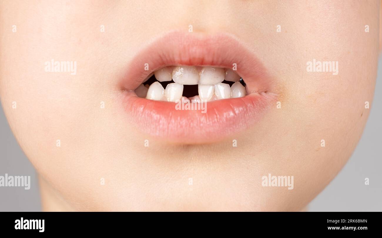 Loss of milk teeth in children. A six-year-old child shows the first ...