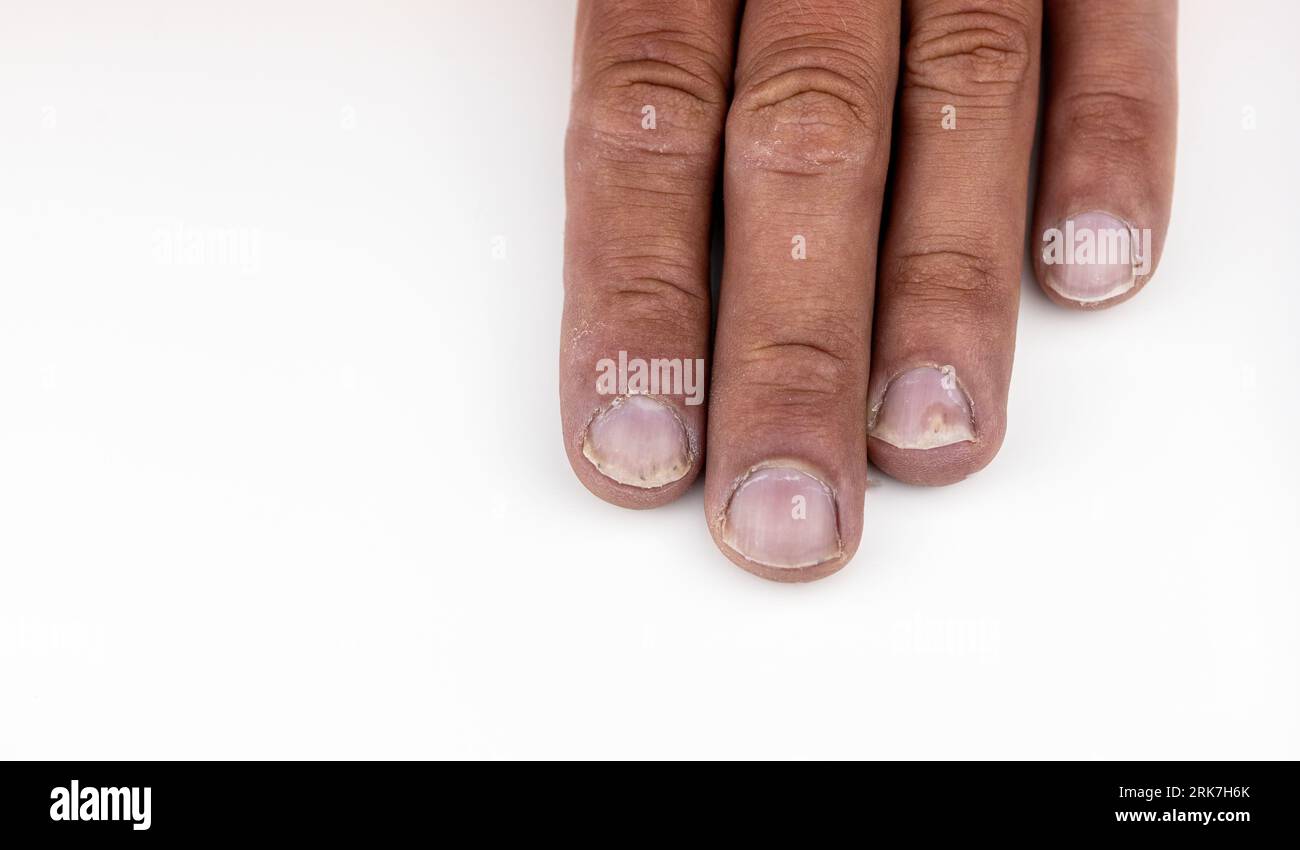 Psoriatic lesion hi-res stock photography and images - Alamy