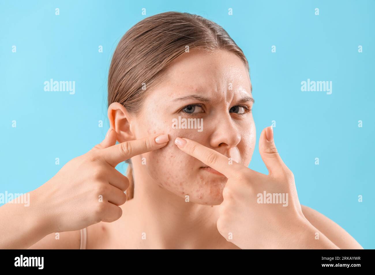 Teenage girl with acne problem squishing pimple on blue background ...