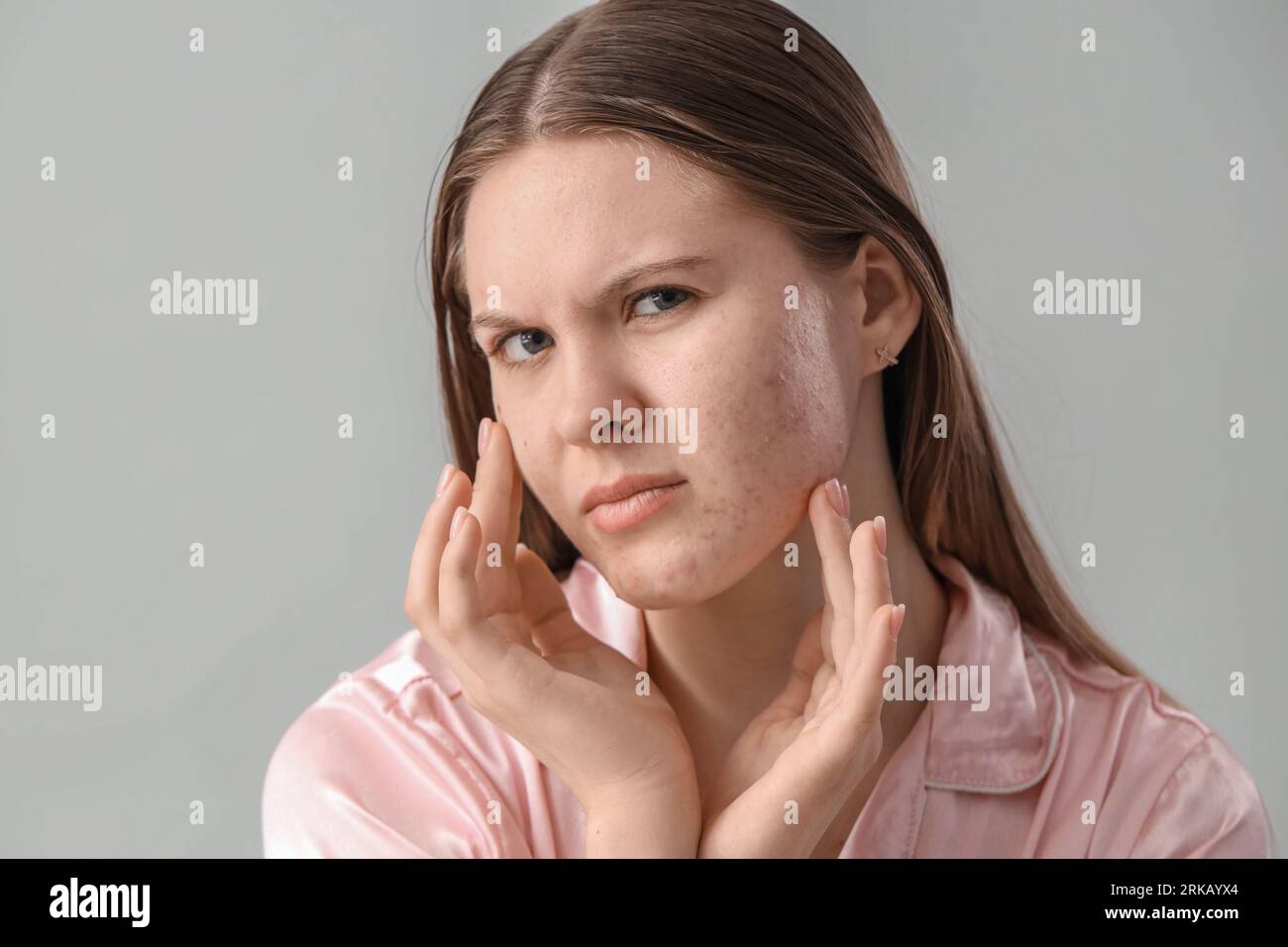 Teenage girl with acne problem on light background, closeup Stock Photo ...