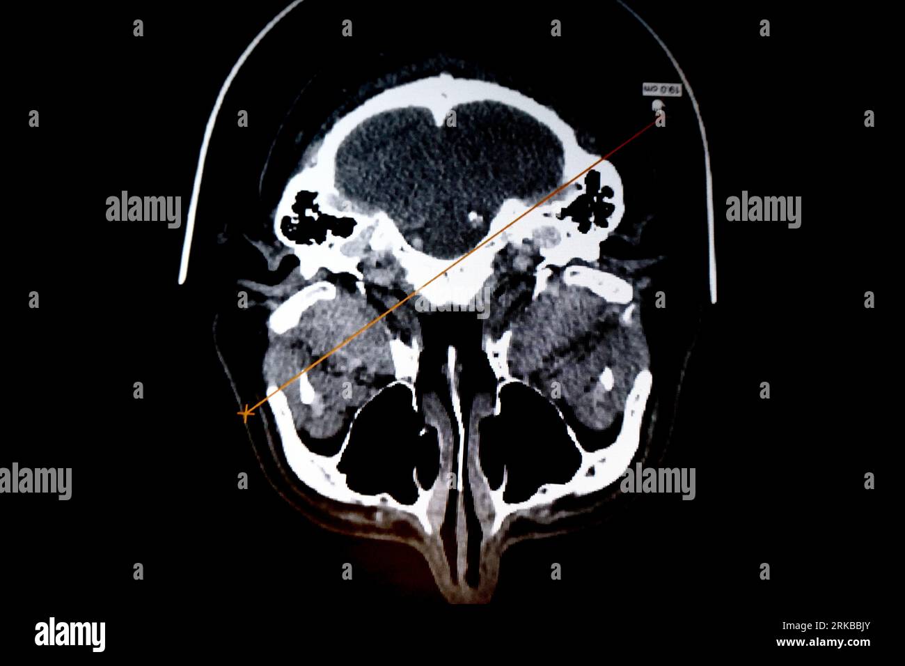 Brain x ray image hi-res stock photography and images - Alamy
