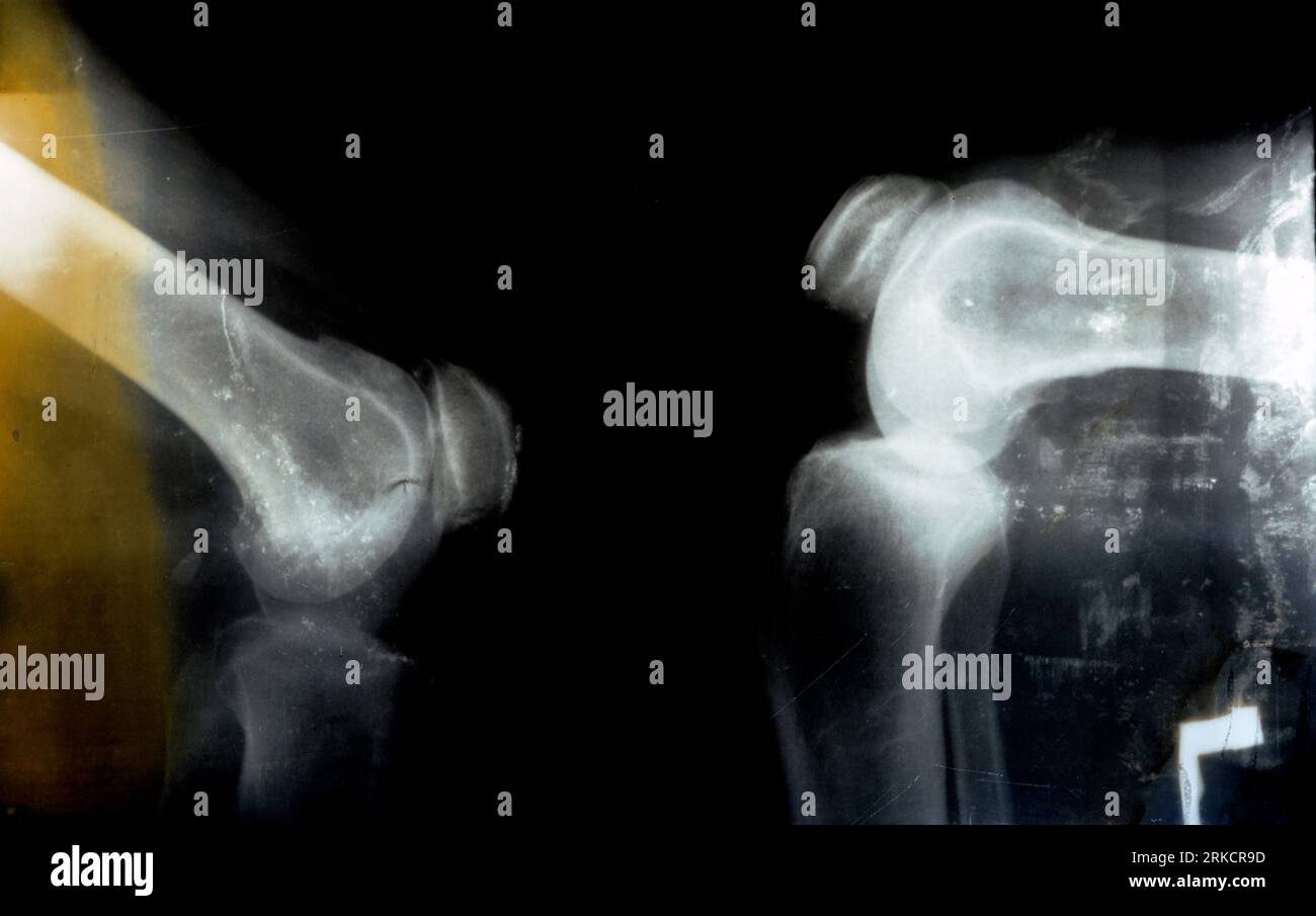 Old retro Plain X ray of the right knee shows apparent joint ...