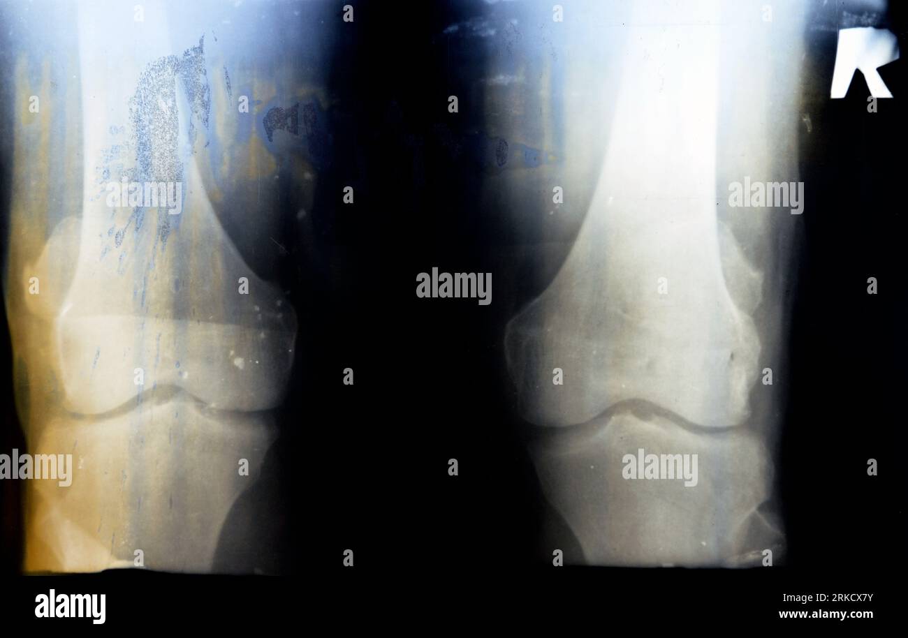 Old retro Plain X ray of the right knee shows apparent joint ...