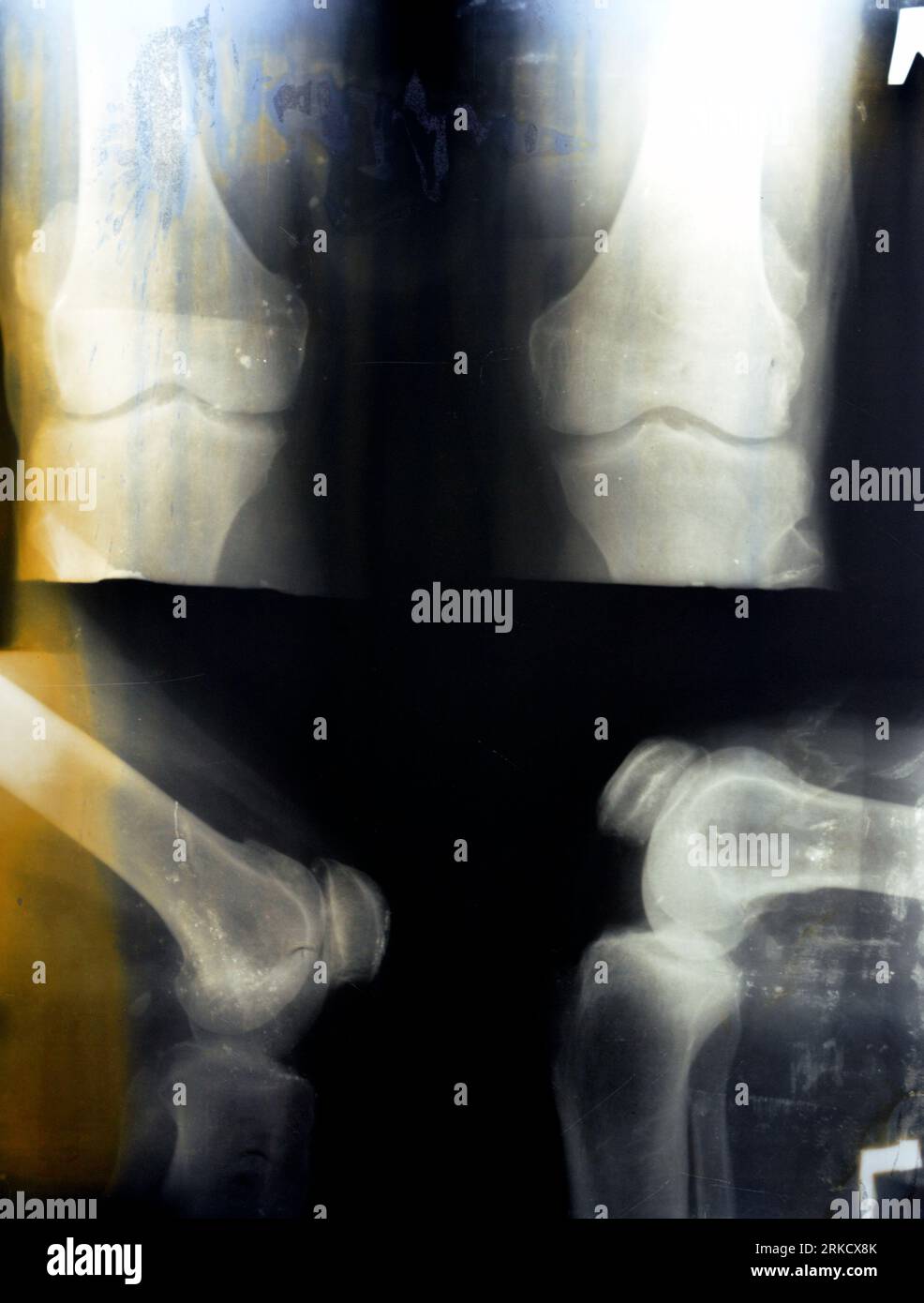 Old retro Plain X ray of the right knee shows apparent joint ...