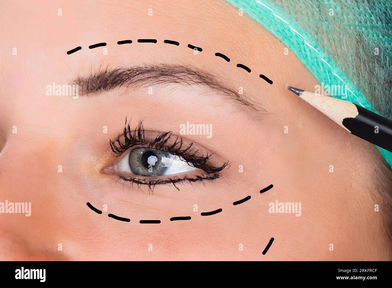 Close-up Of A Surgeon Drawing Perforation Lines On Young Woman's Face ...